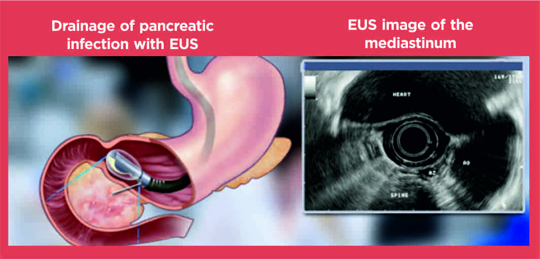 Understanding Endoscopic Ultrasound(EUS) - Sai Institute of ...