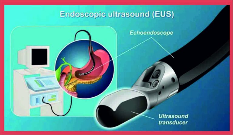 Understanding Endoscopic Ultrasound(EUS) - Sai Institute of ...